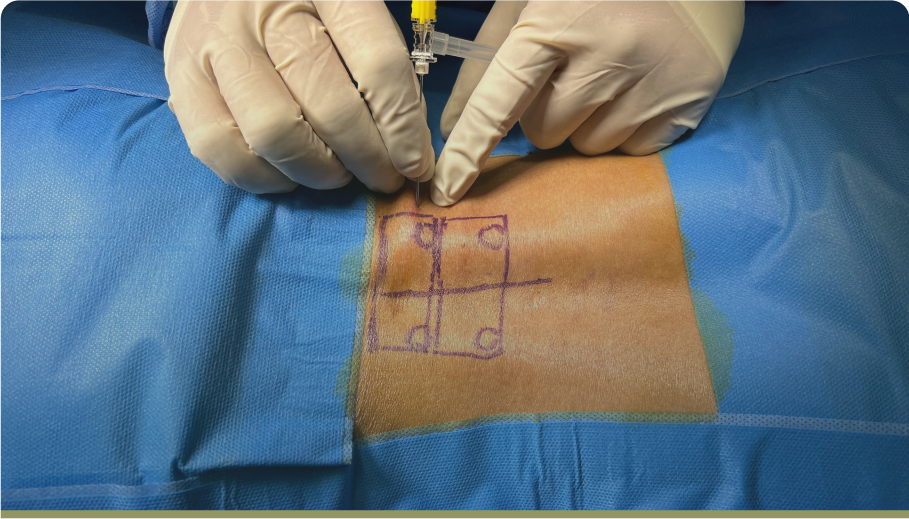 Rizotomia Facetária por Radiofrequência - Dr. Flávio Zelada