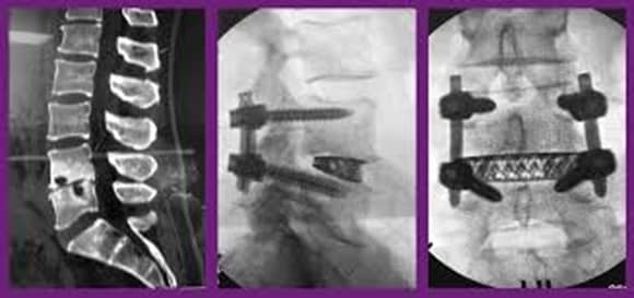 Cirurgia de artrodese lombar: saiba tudo sobre!
