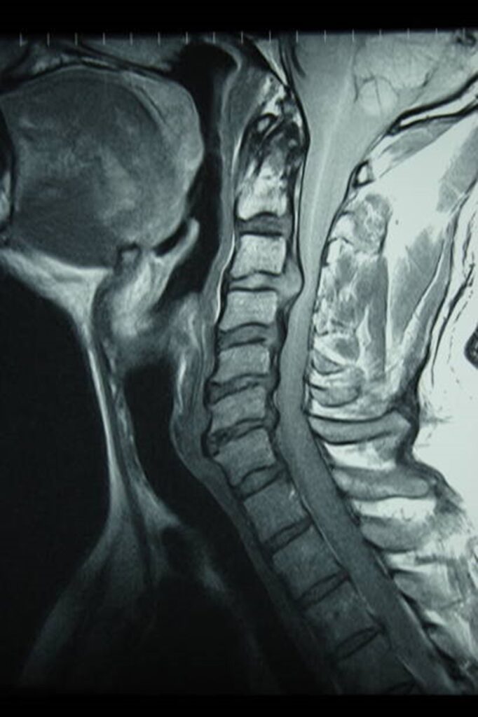 Descompressão medular: o que é, como é feita e recuperação