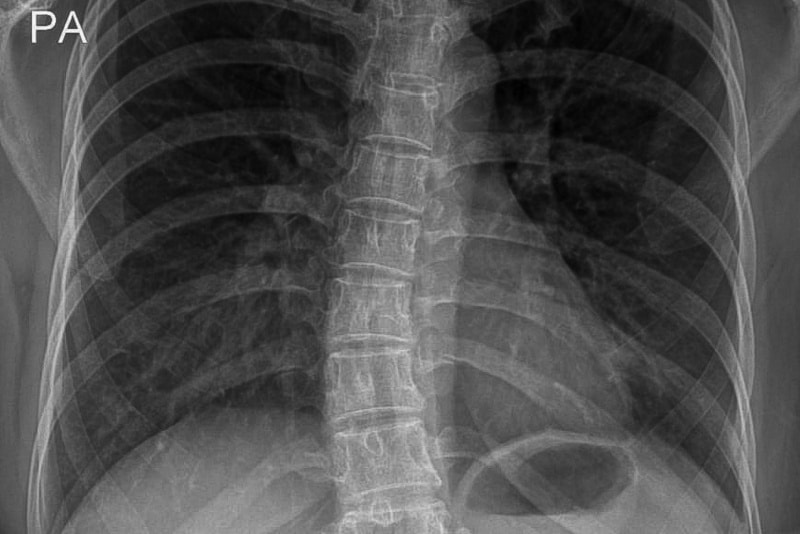 Escoliose leve: o que é, como identificar e quando tratar